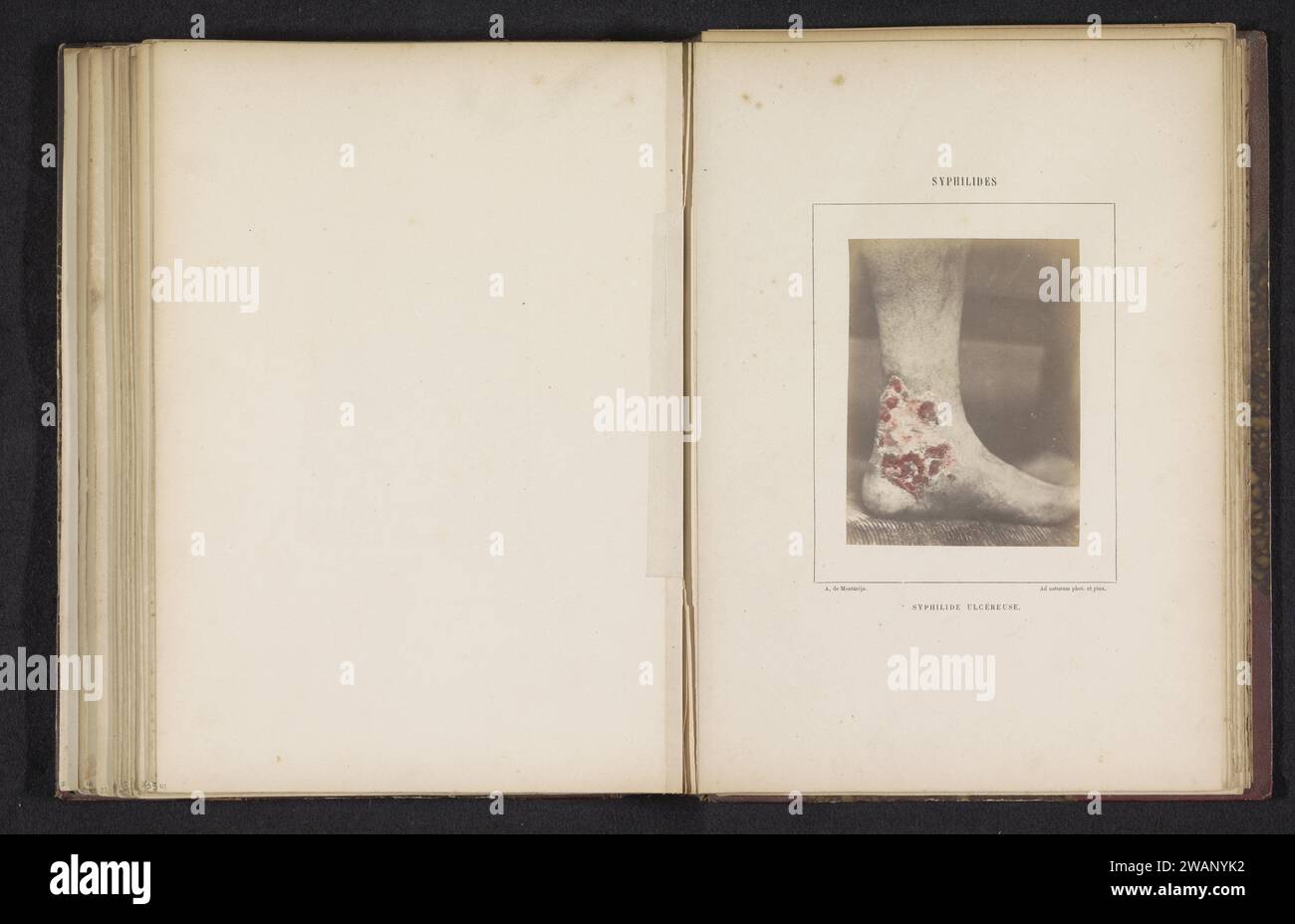 Swing skin rash on a foot, caused by syphilis, A. de Montméja, c. 1860 ...