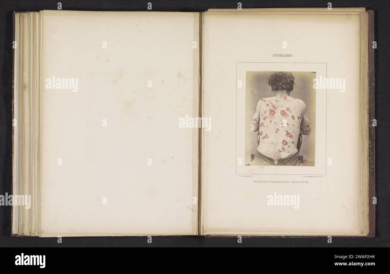 Man with skin rashes caused by syphilis, A. de Montméja, c. 1860 - c ...
