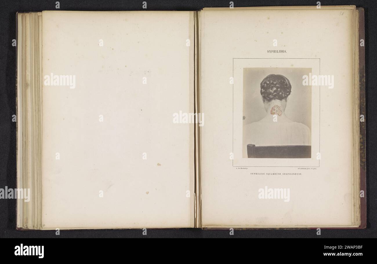 Woman with skin rash in her neck caused by syphilis, A. de Montméja, c ...