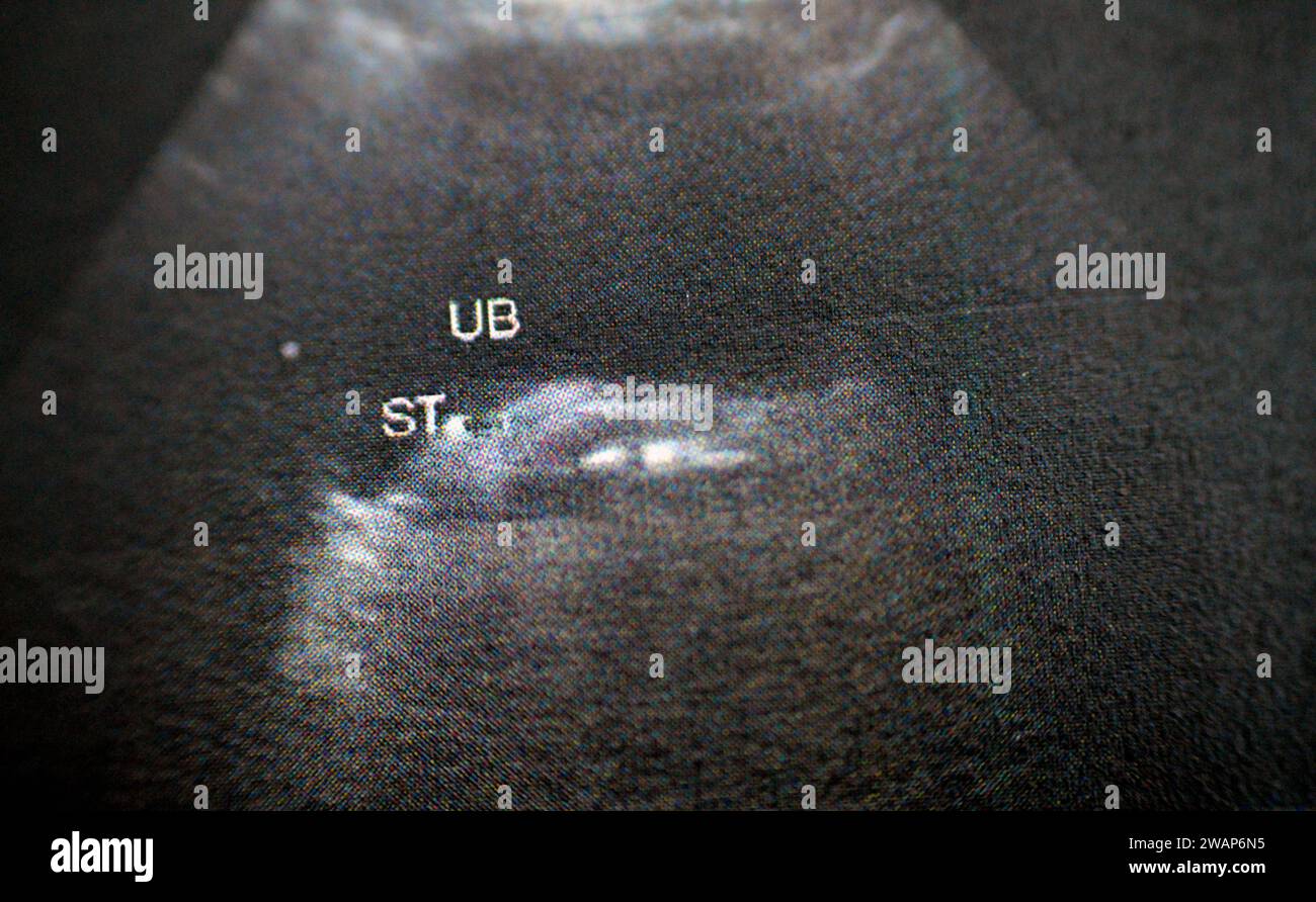 Pelviabdominal ultrasound reveals 9mm stone at the right vesicoureteric ...