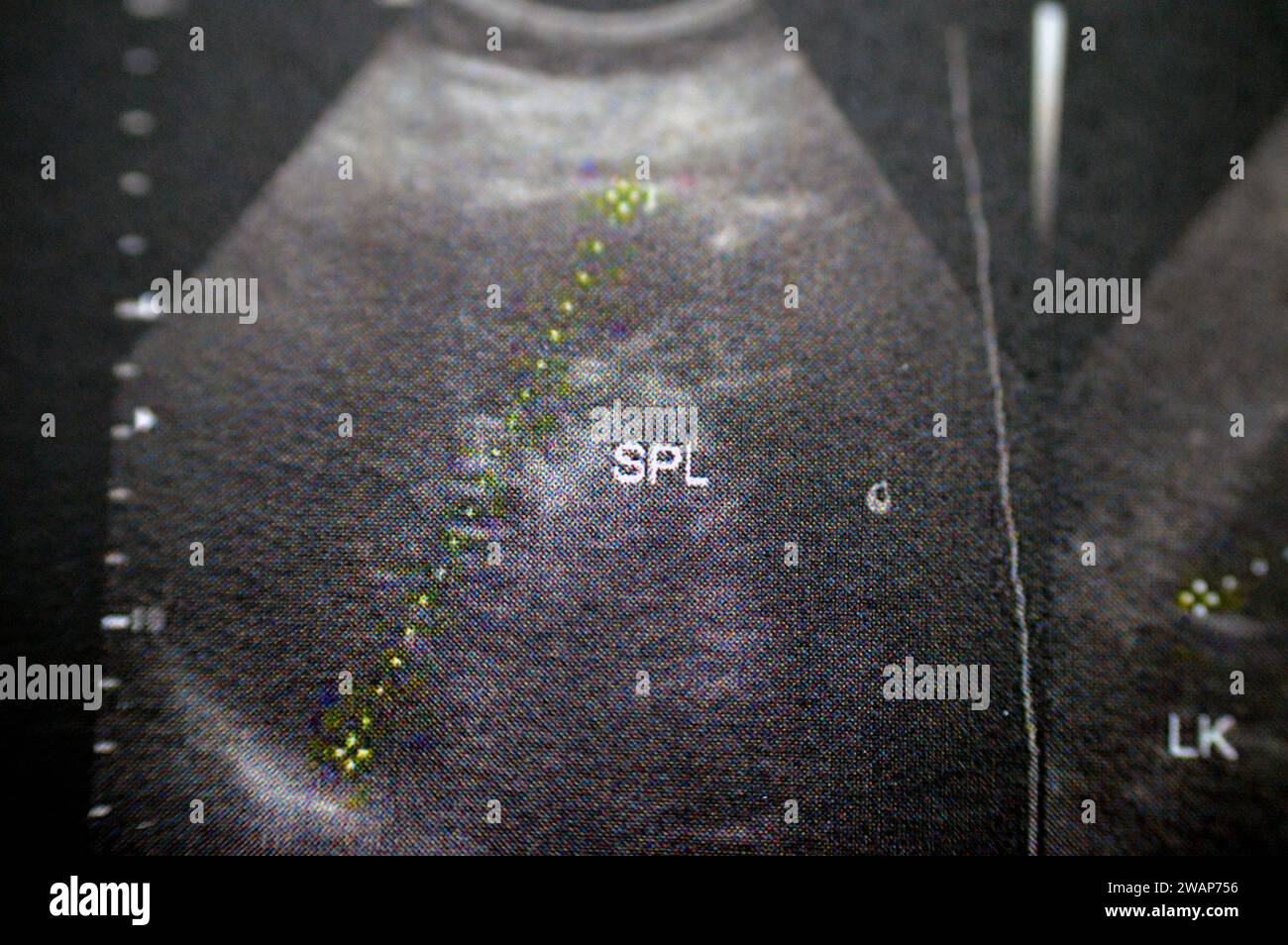 The spleen of an average size 10 CM, and of homogeneous uniform texture ...