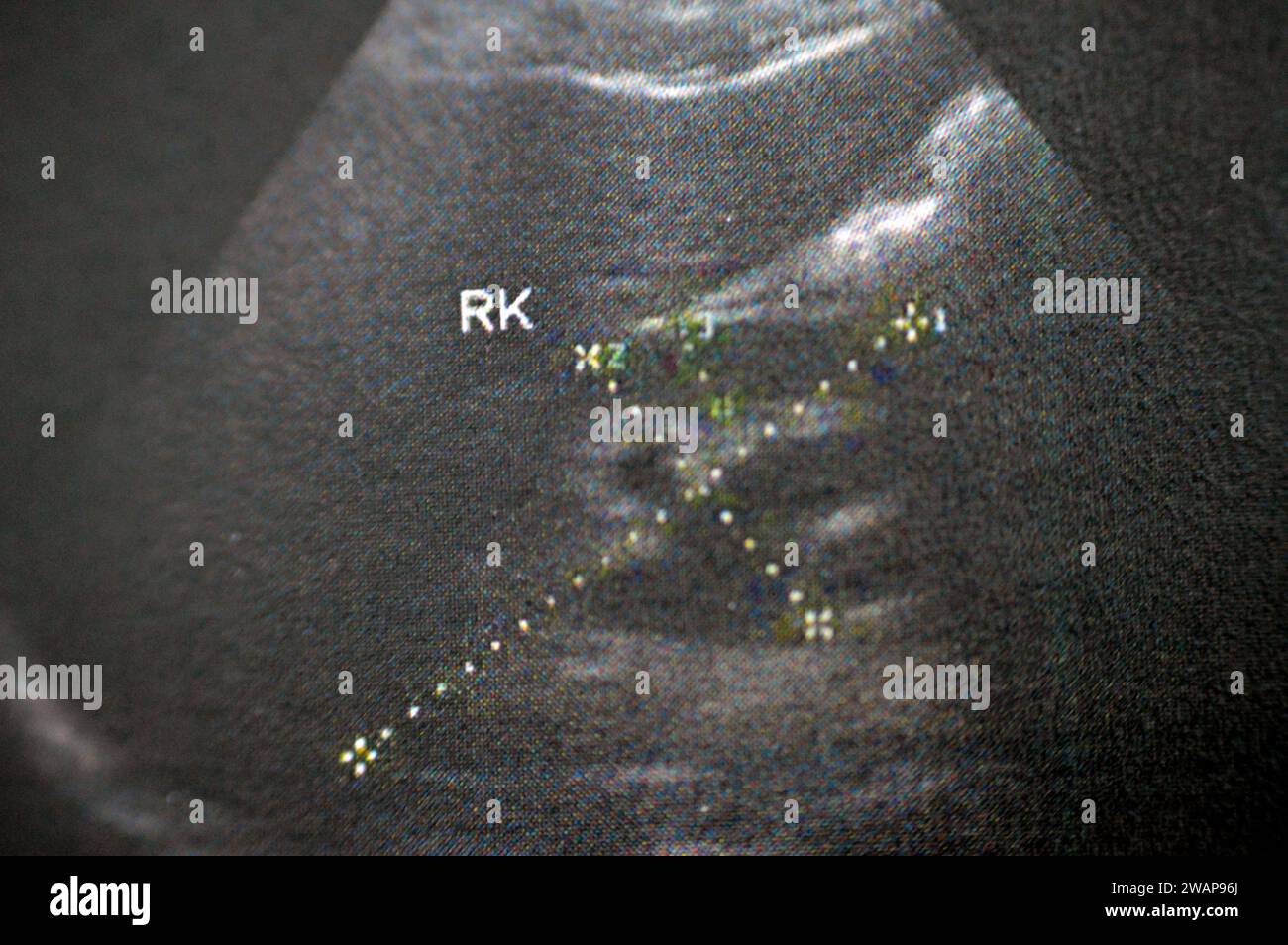 Right kidney is of normal size, normal cortical thickness and ...