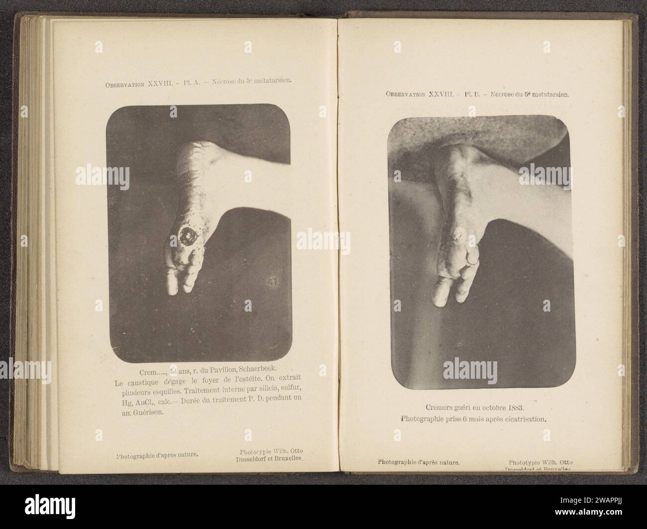 Foot with a necrotic wound on a metatarsal, c. 1874 - in or before 1884 ...