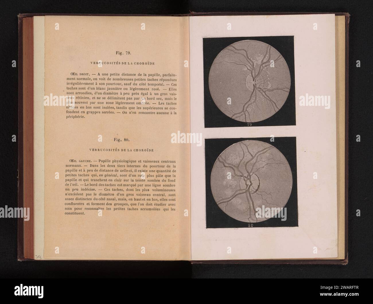 Photo production of two anatomical drawings of a tumor on the vascular ...