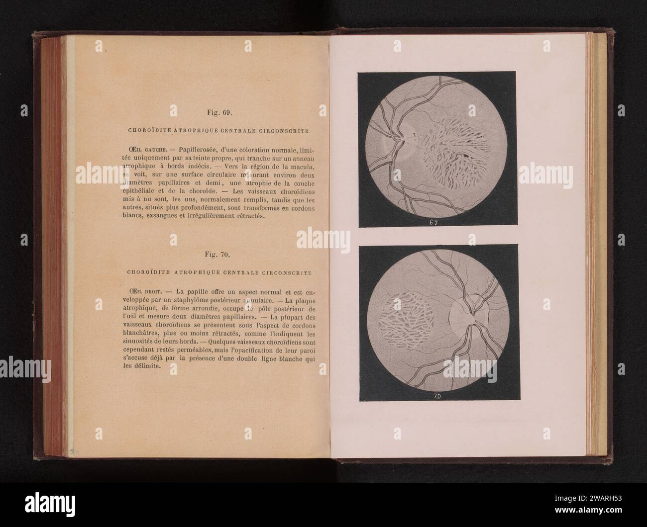 Photo production of two anatomical drawings of an inflammation of the ...