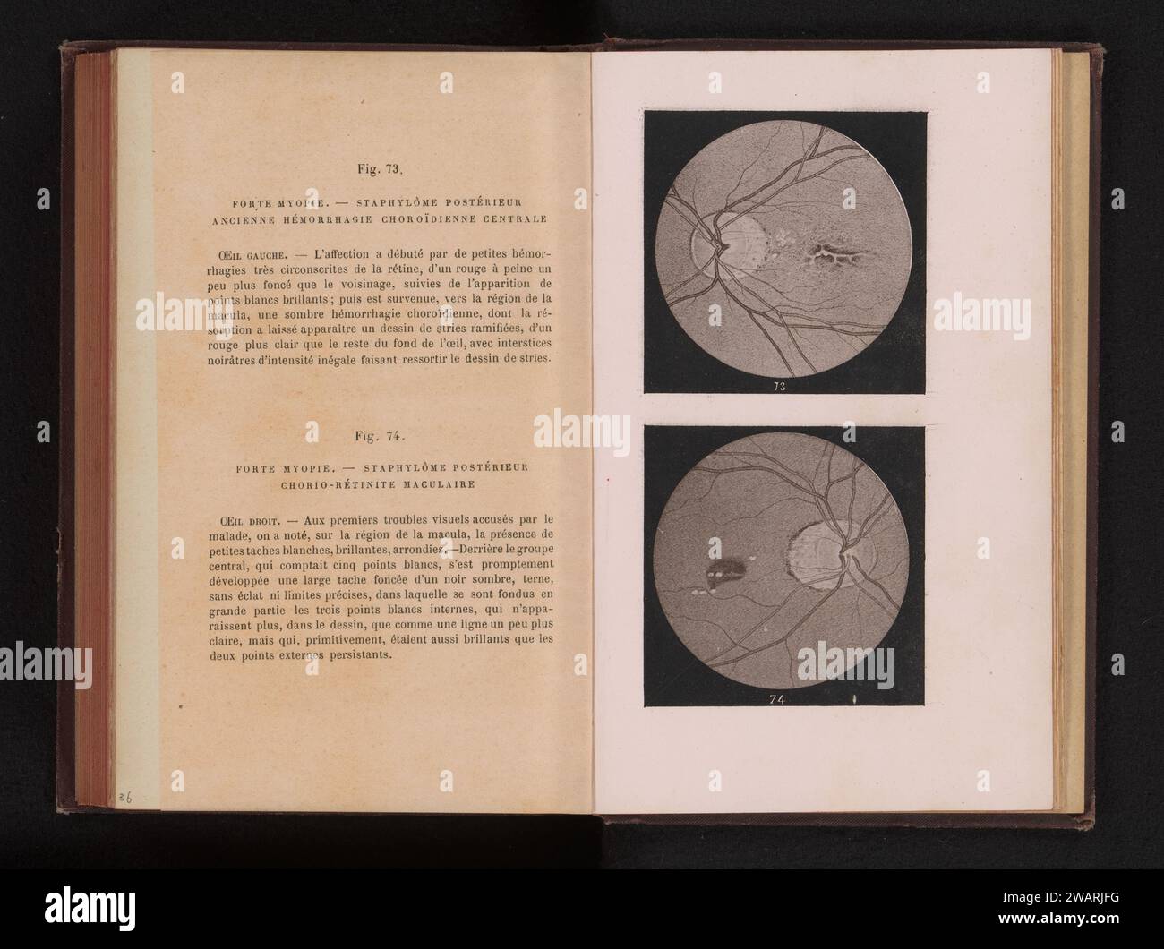 Photo production of two anatomical drawings of a eye of myopia ...