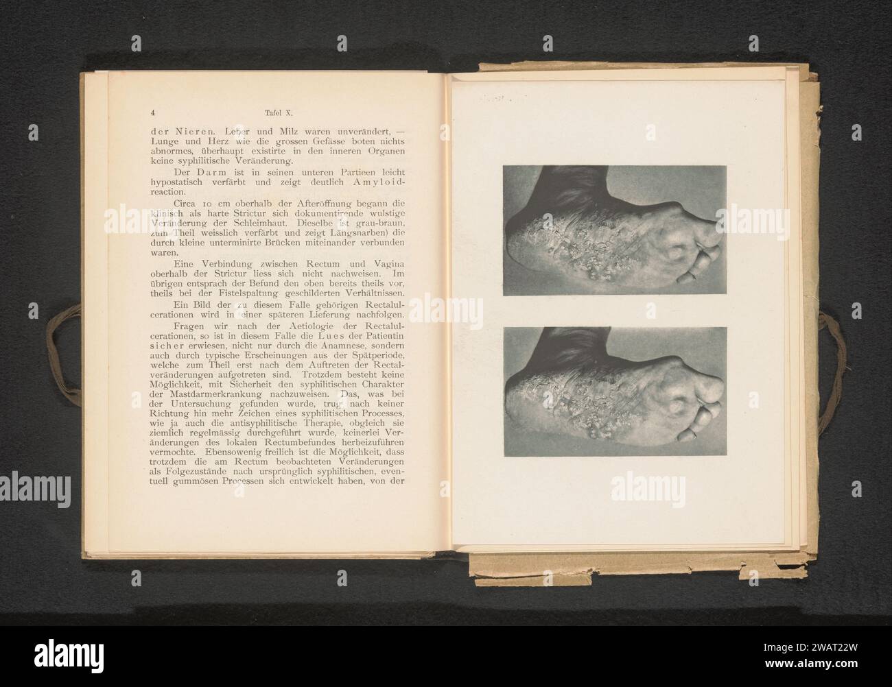 Two looks of a foot sole with symptoms of syphilis, Albert Ludwig ...