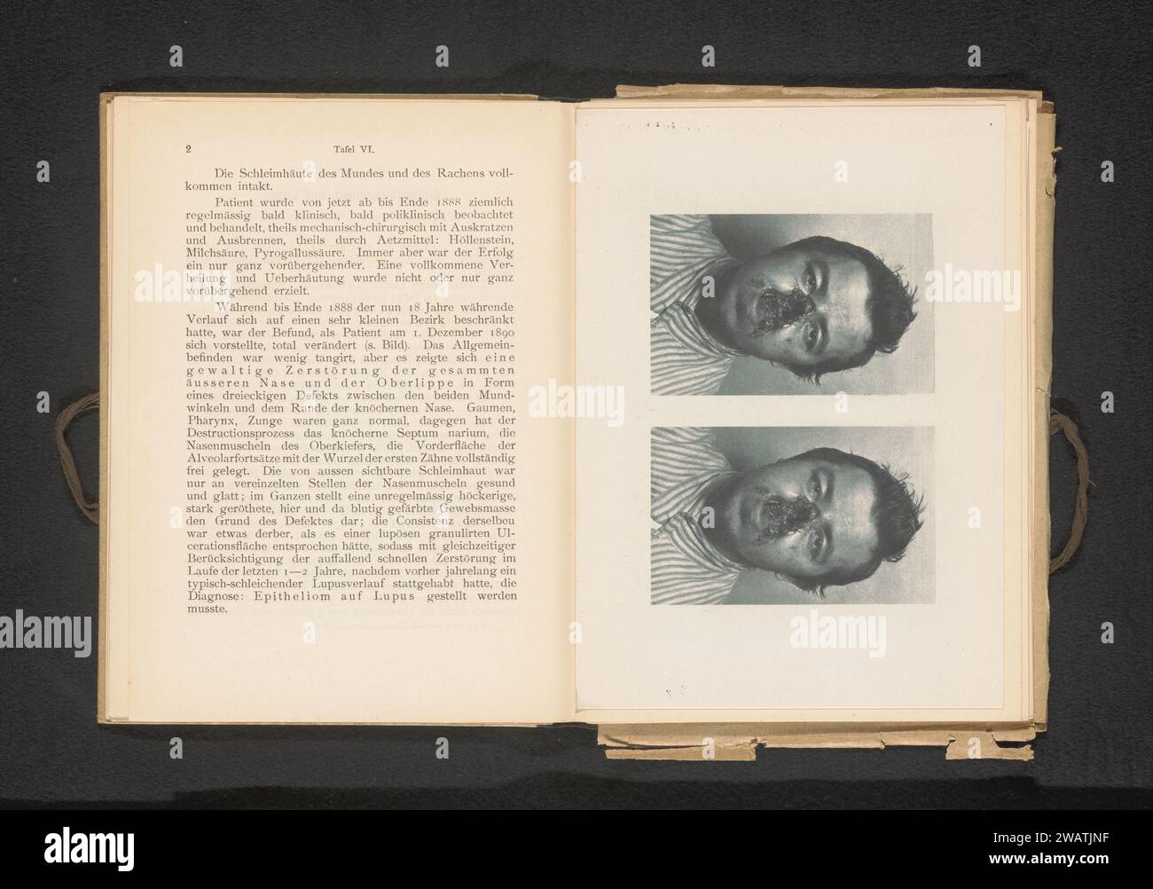 Two portraits of a patient with a carcinoma through Huidlupus, Albert ...