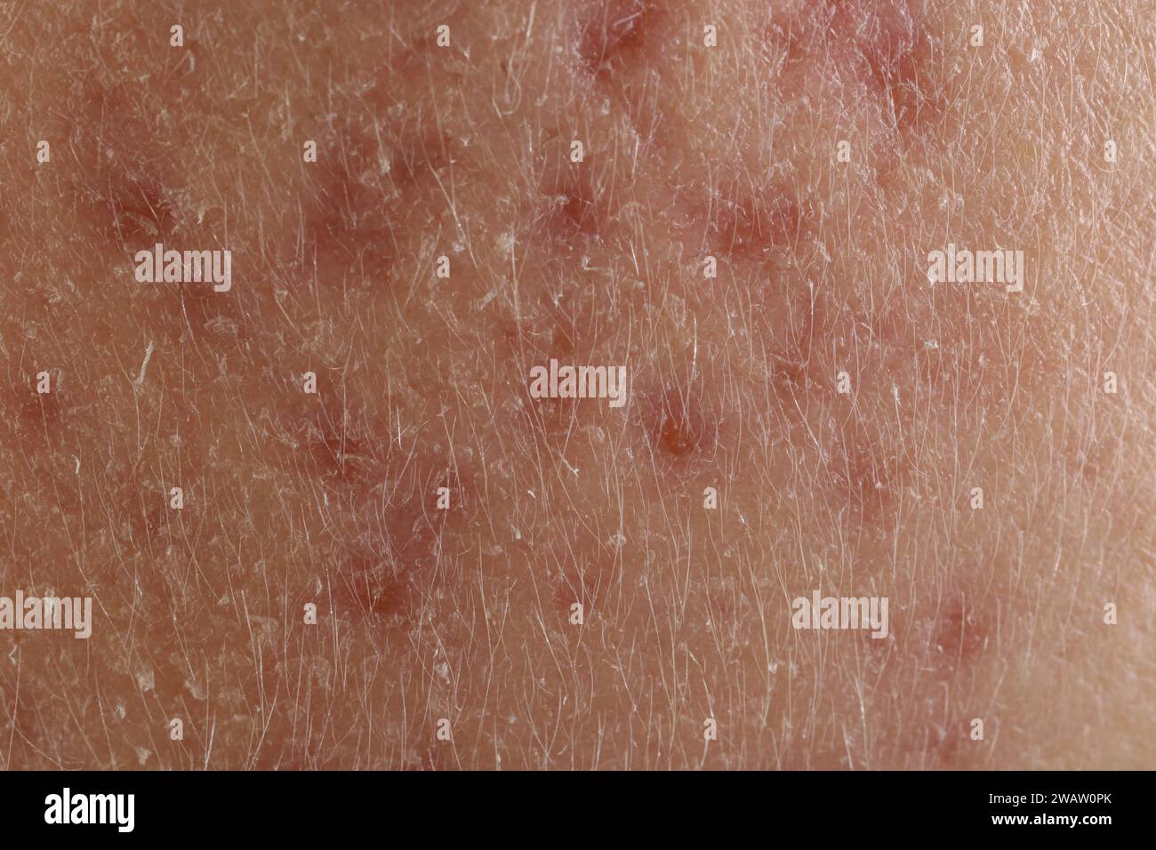 Texture of skin with acne problem as background, macro view Stock Photo ...