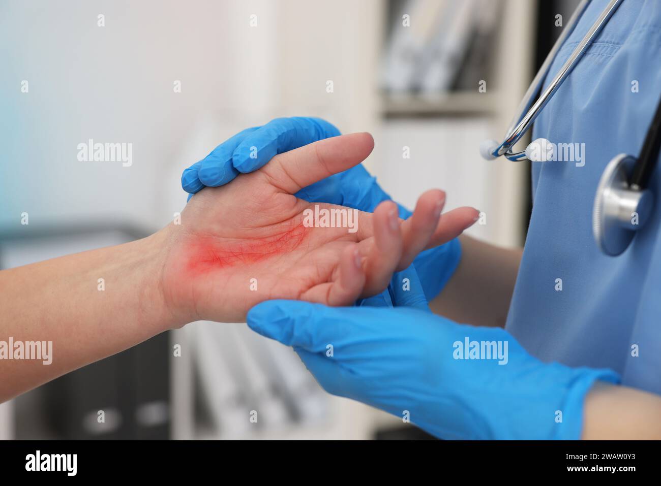 Doctor examining patient's burned hand in hospital, closeup Stock Photo ...