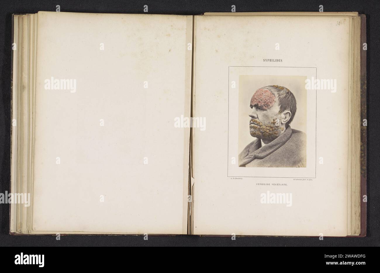 Portrait of an unknown man with skin rash and bumps caused by syphilis ...