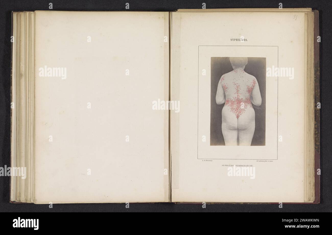 Syphilis rash hi-res stock photography and images - Alamy