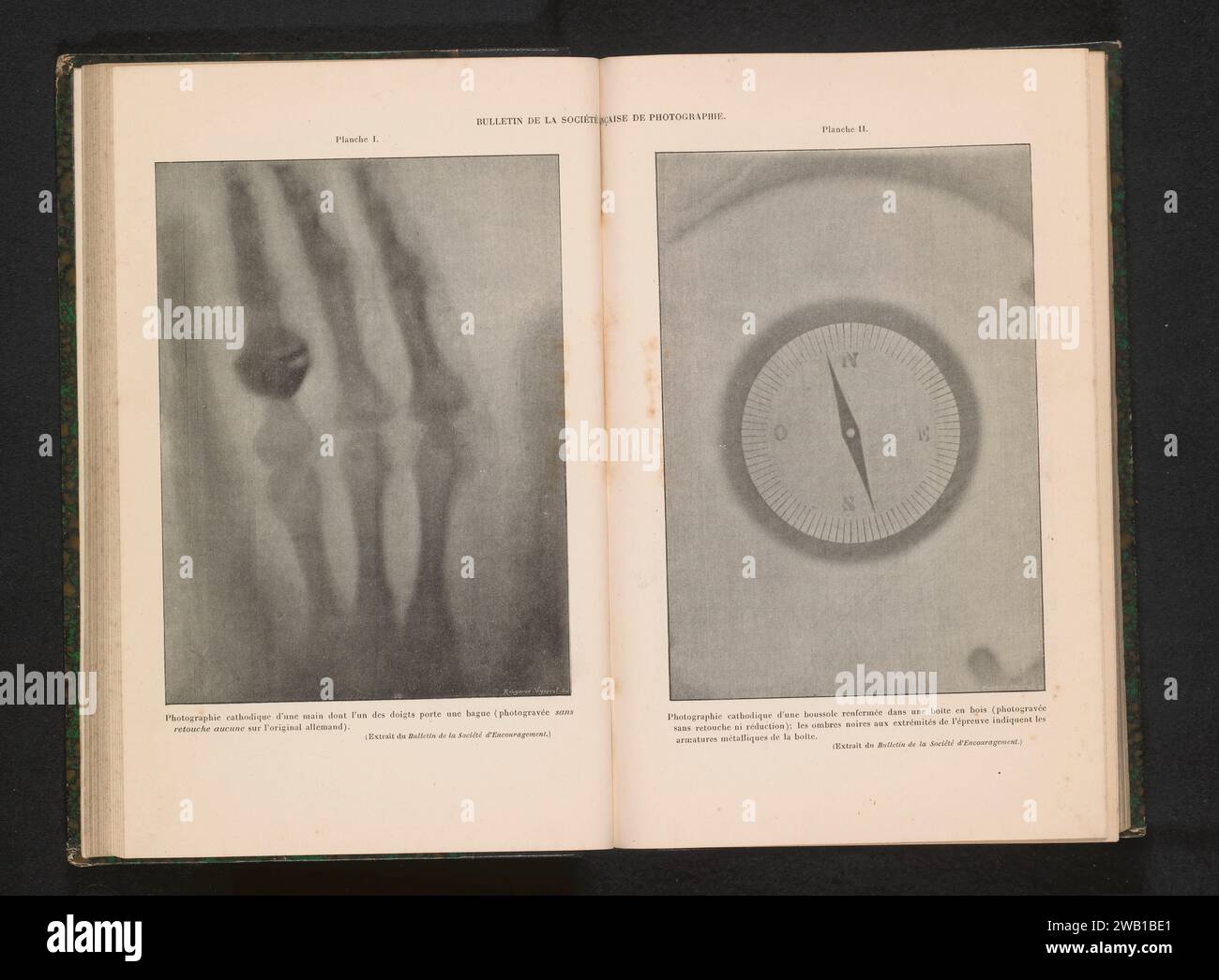 Hand x ray ring hi-res stock photography and images - Alamy