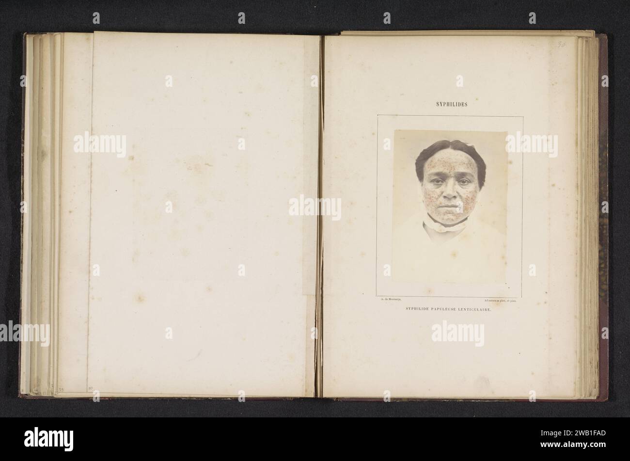 Skin rash caused by syphilis, A. de Montméja, c. 1860 - c. 1868 ...
