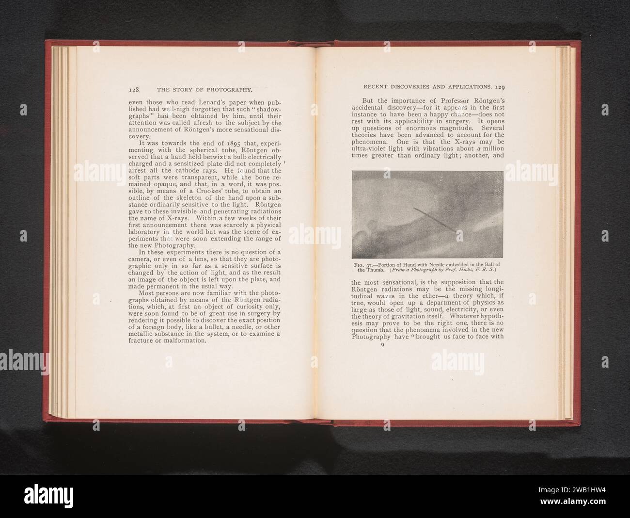 Detail of a needle in a ball of a thumb, F.R.S. Hicks, c. 1894 - in or ...