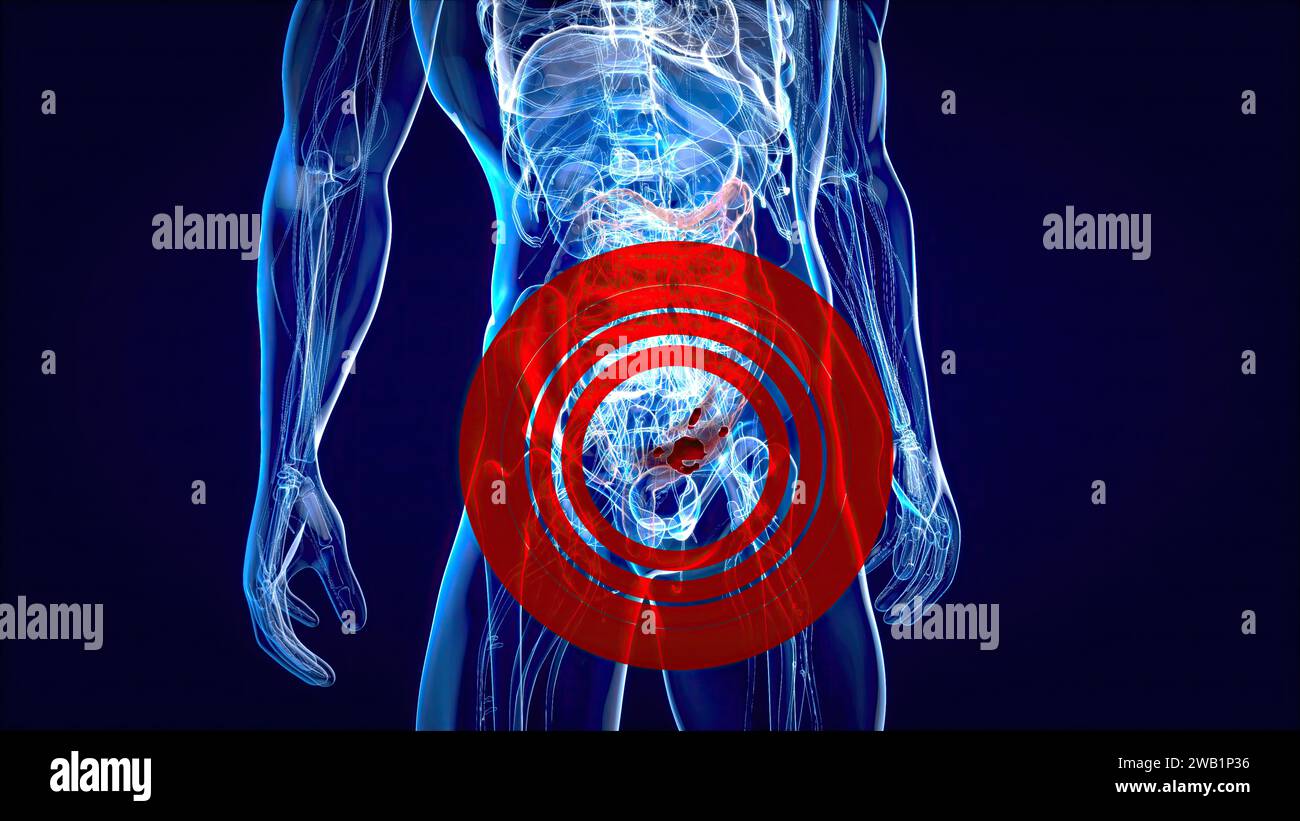 Abstract illustration of the colon cancer Stock Photo - Alamy
