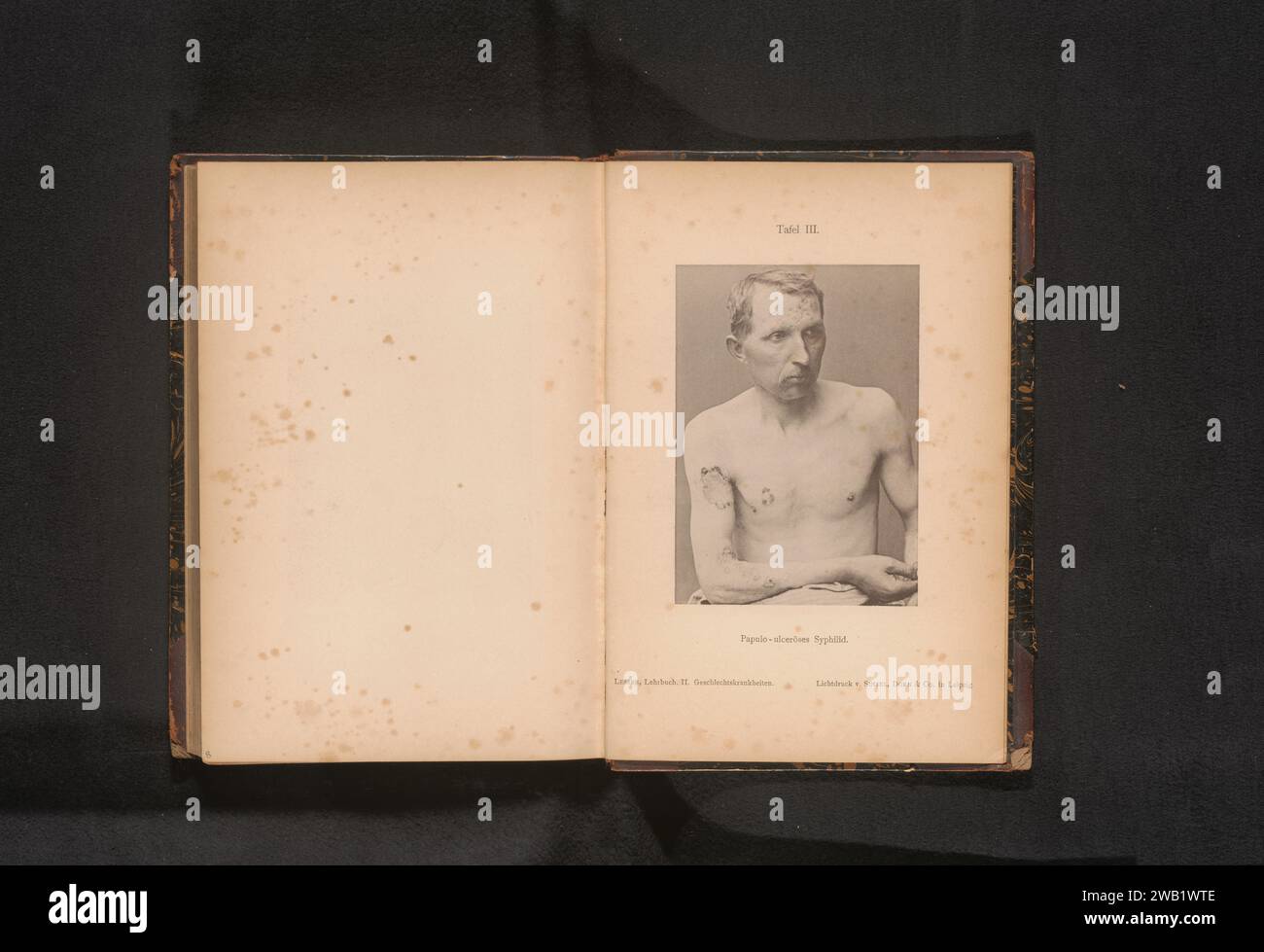 Unknown man with skin rash caused by syphilis, anonymous, c. 1880 - in ...