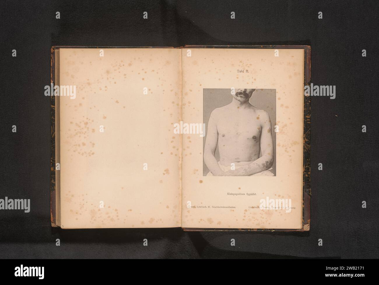 Unknown man with skin rash caused by syphilis, anonymous, c. 1880 - in ...