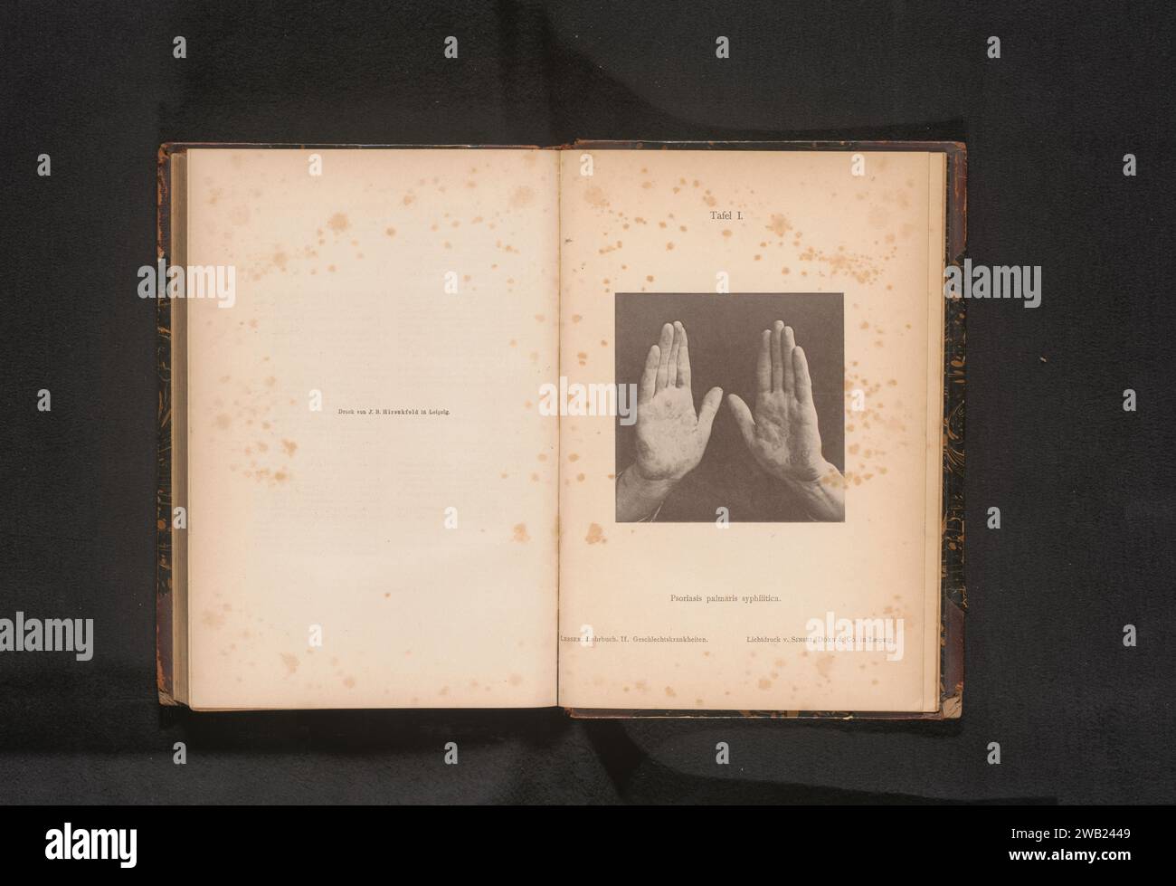 Hands with skin rashes caused by syphilis, anonymous, c. 1880 - in or ...