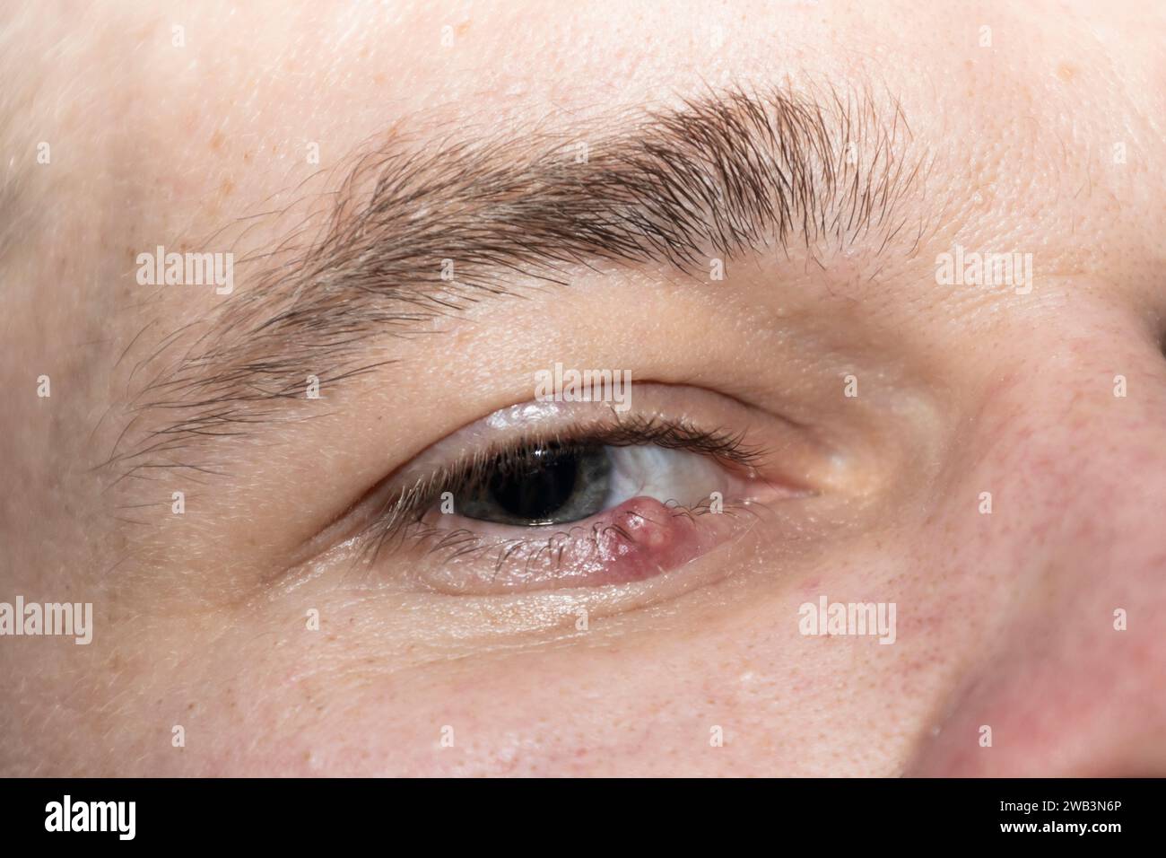 Eye of a guy with stye close-up. Acute red purulent inflammation of the ...