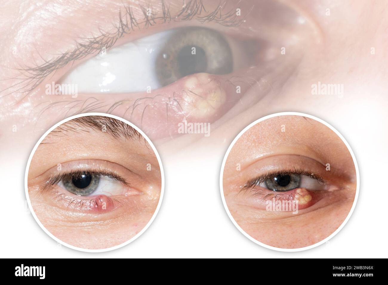 Set of the photos with Eye of a guy with stye close-up. Acute red ...