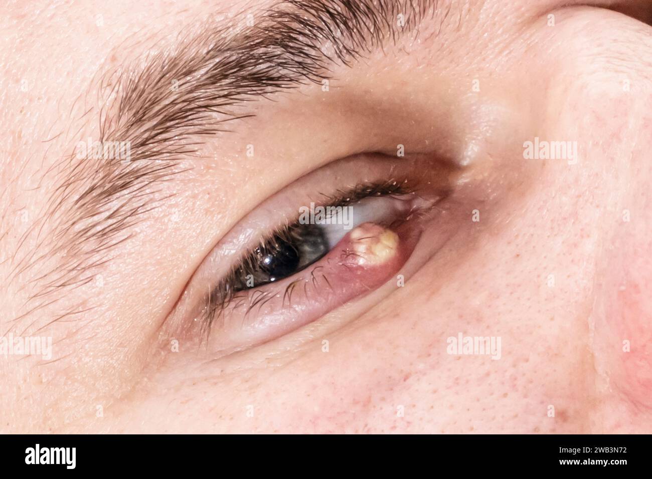 Eye of a guy with stye close-up. Acute red purulent inflammation of the ...