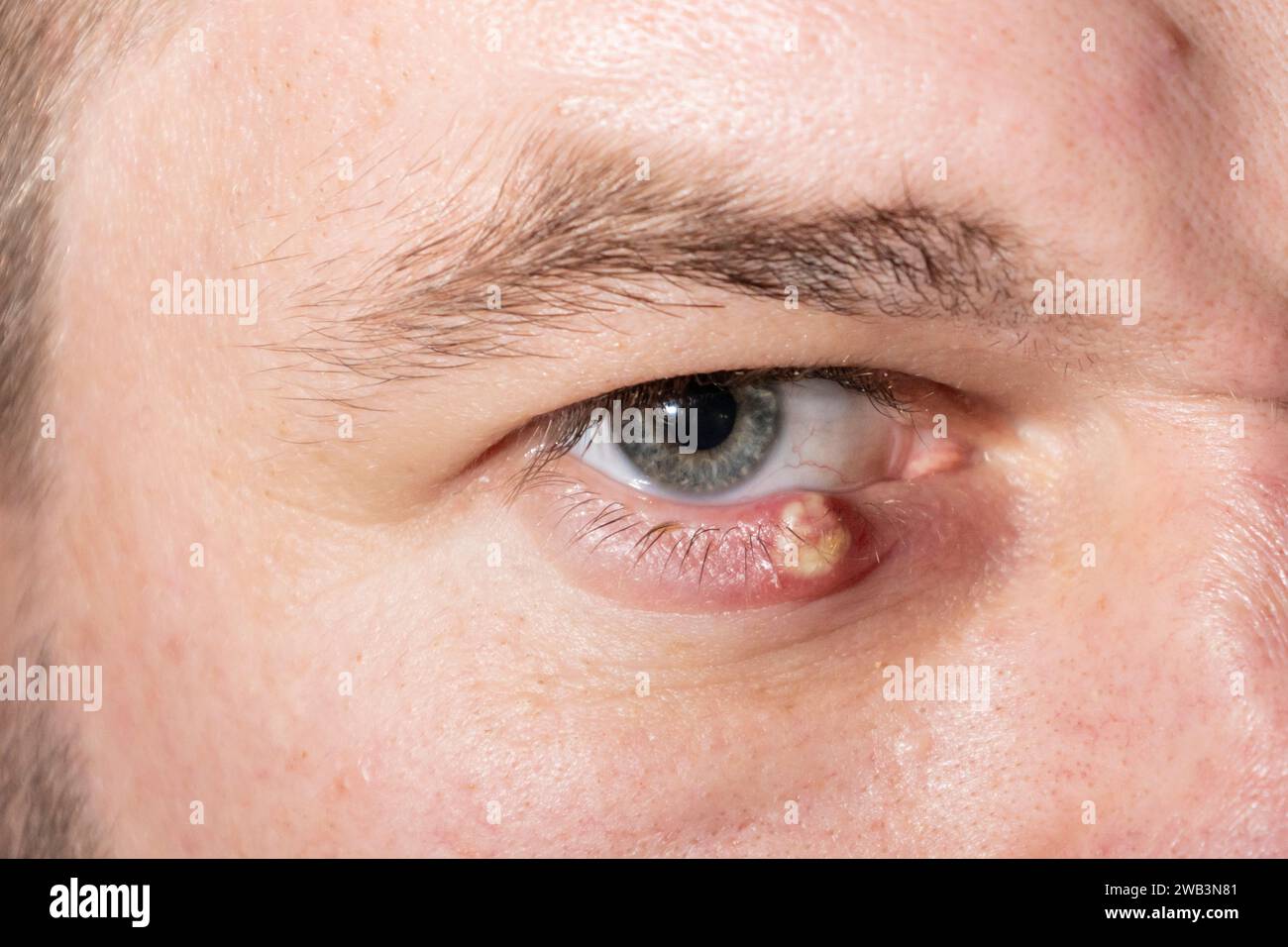 Eye of a guy with stye close-up. Acute red purulent inflammation of the ...