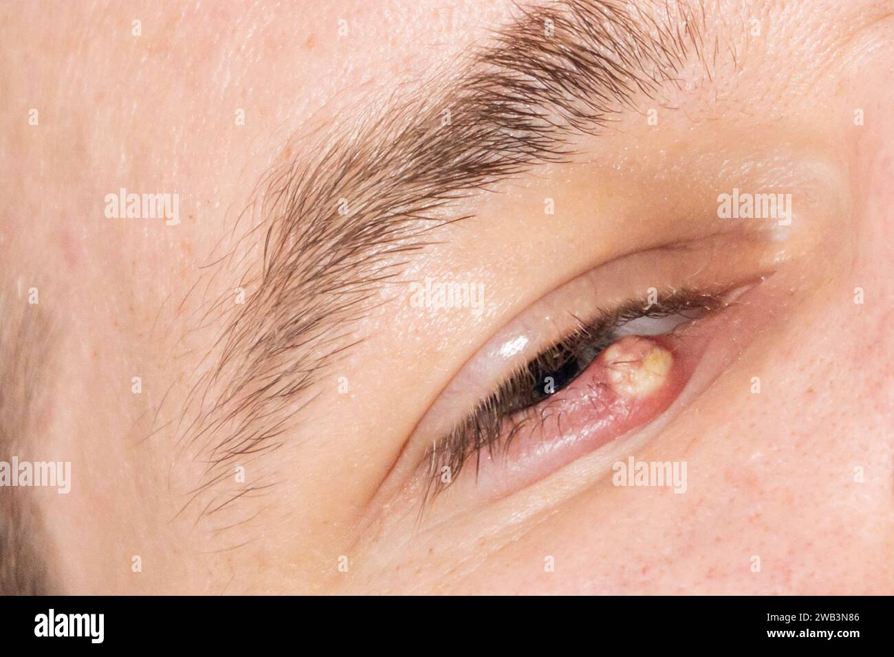 Eye of a guy with stye close-up. Acute red purulent inflammation of the ...