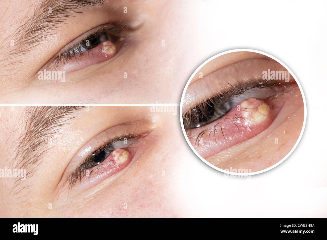 Set of the photos with Eye of a guy with stye close-up. Acute red ...
