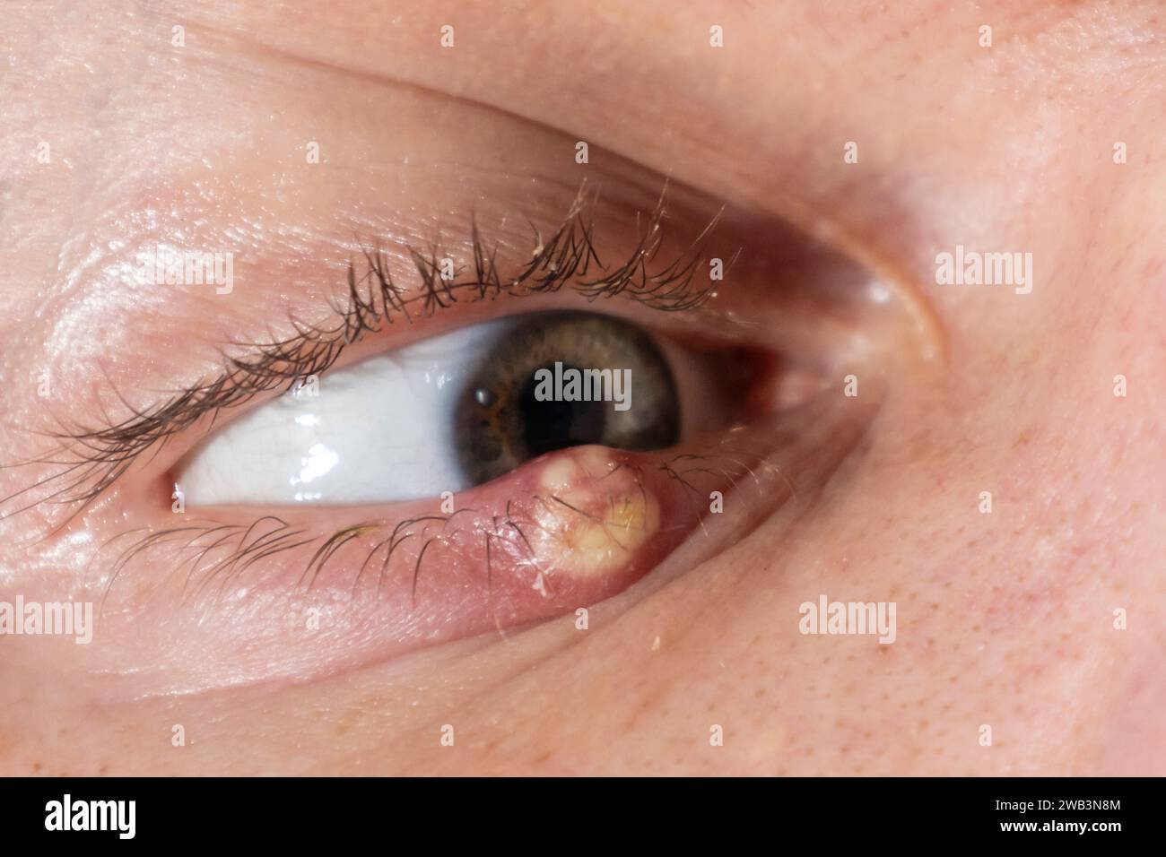 Chalazion hi-res stock photography and images - Alamy