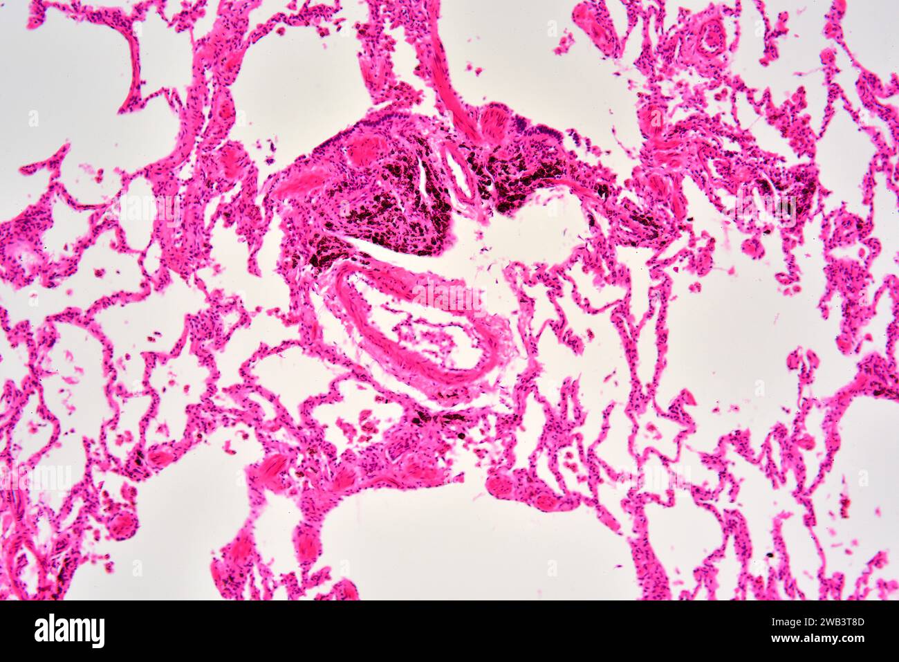 Photomicrograph of human lung alveoli hi-res stock photography and ...