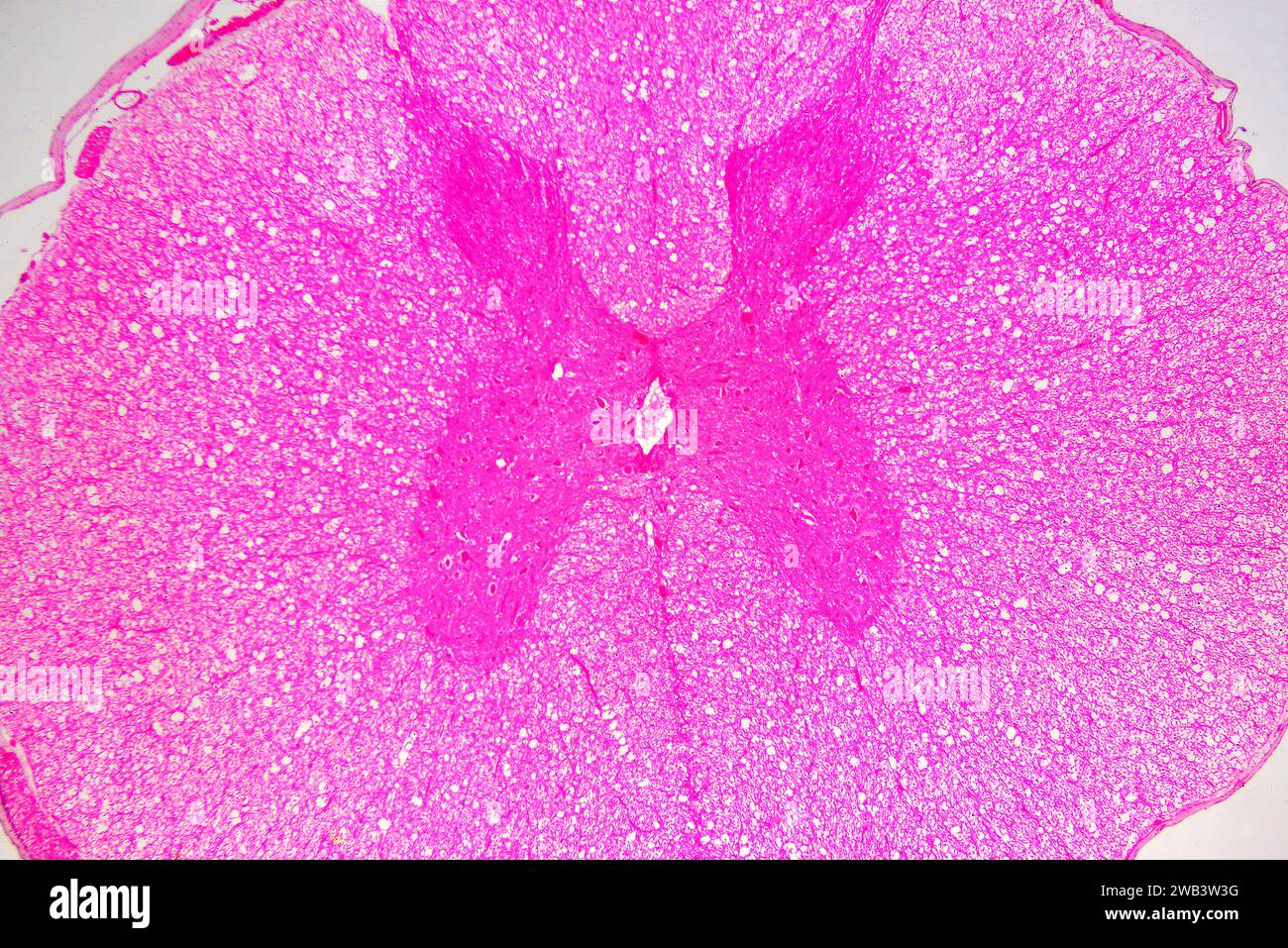 Human spinal cord showing meninges, white matter, grey matter, dorsal and ventral horns and ...