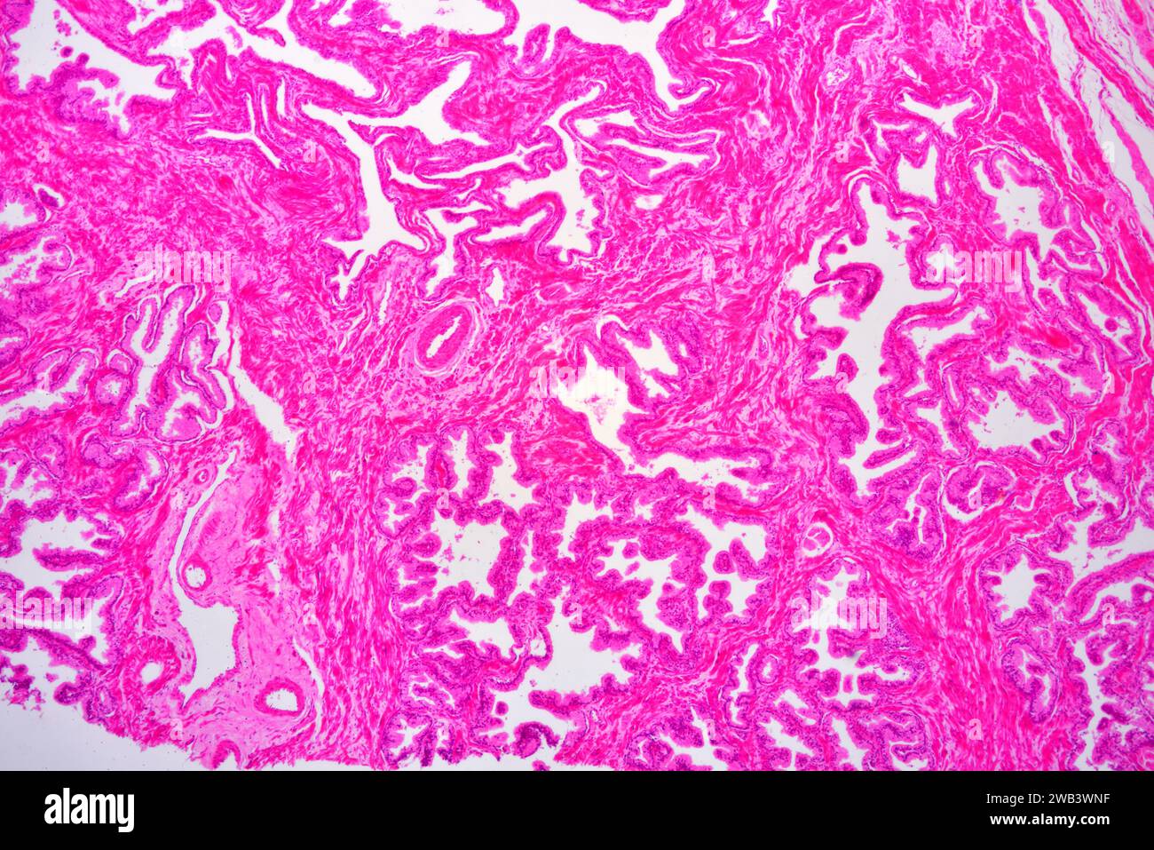 Human prostata showing connective tissue, lumen of glands and ...