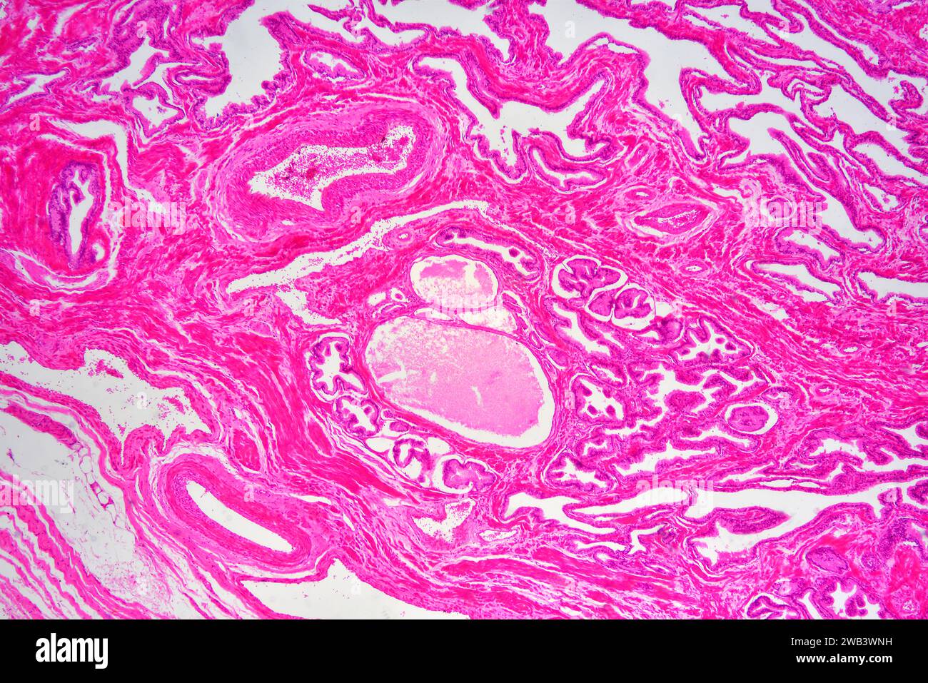 Human prostata showing connective tissue, lumen of glands, blood ...
