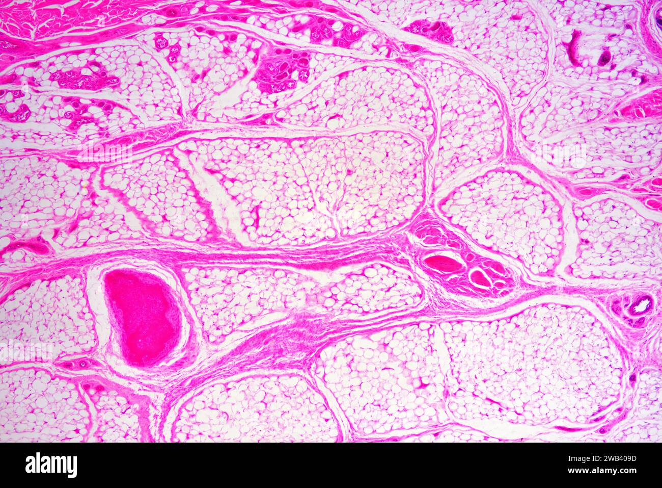 Adipose tissue human hi-res stock photography and images - Alamy