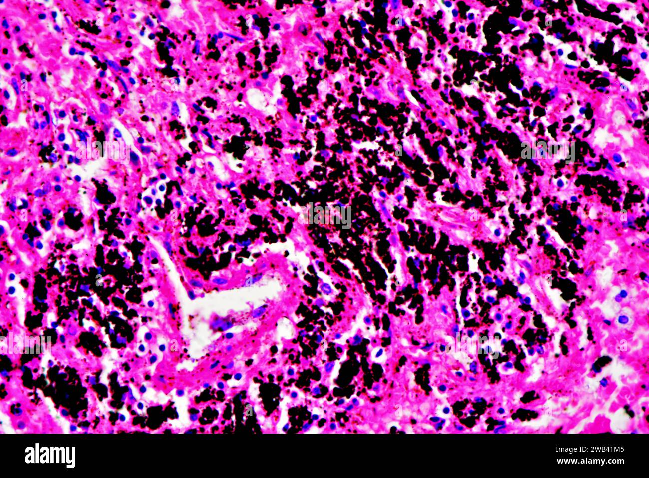 Human smoker's lung with carbon particles (black). Photomicrograph X300 ...