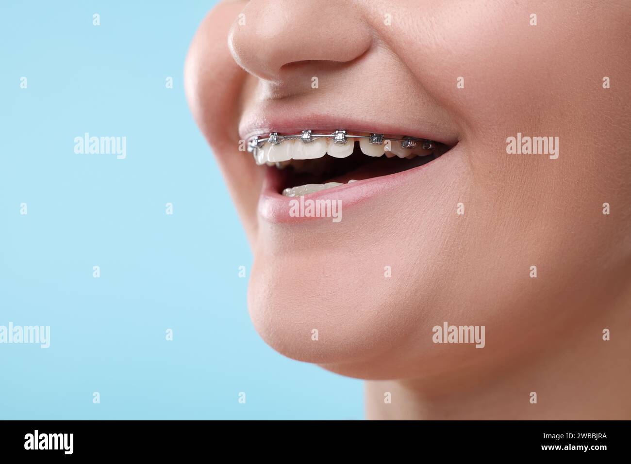 Adult braces open mouth hi-res stock photography and images - Alamy