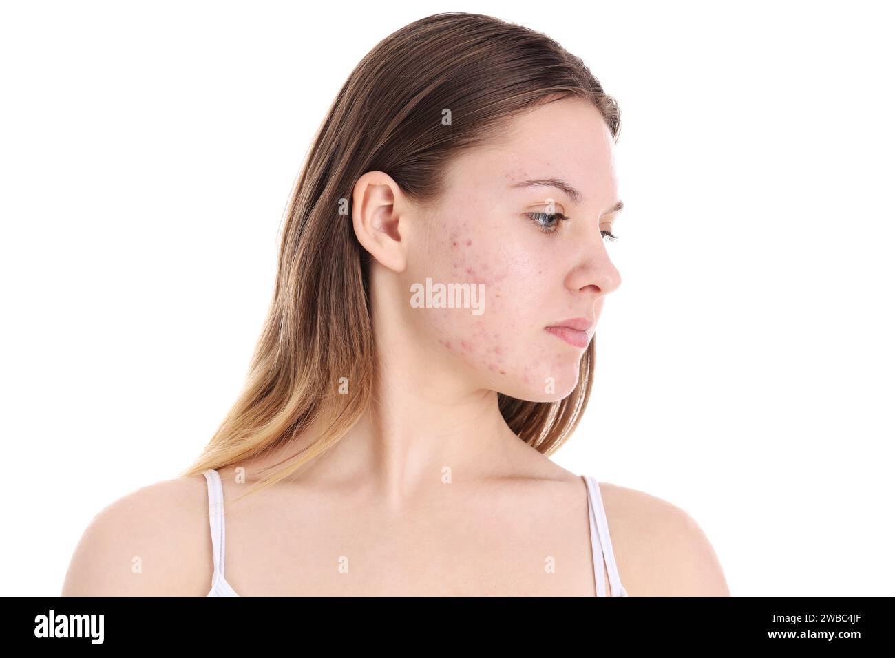 Teenage girl with acne problem on white background, closeup Stock Photo ...