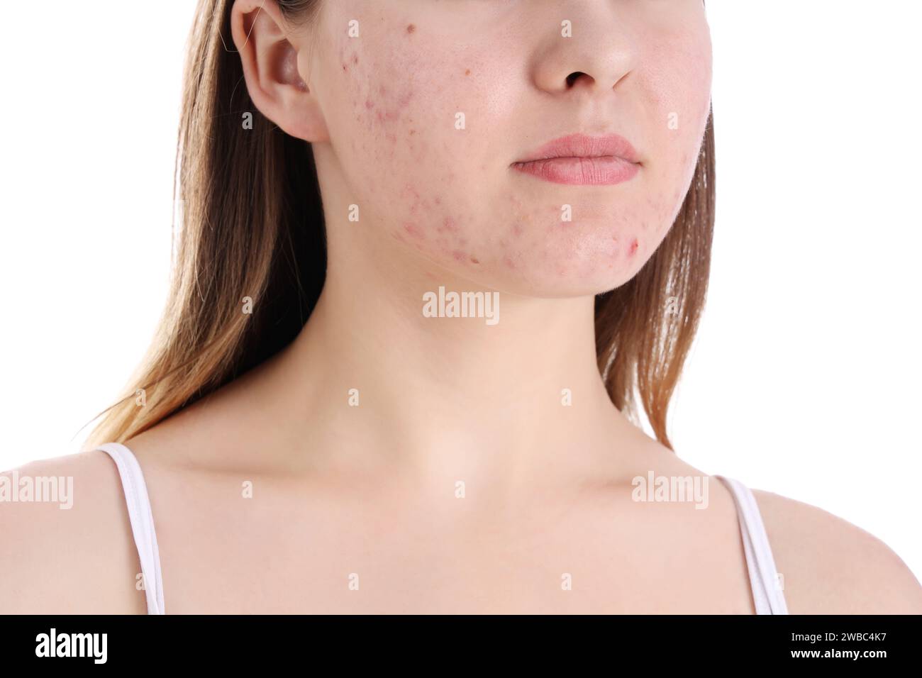 Teenage girl with acne problem on white background, closeup Stock Photo ...