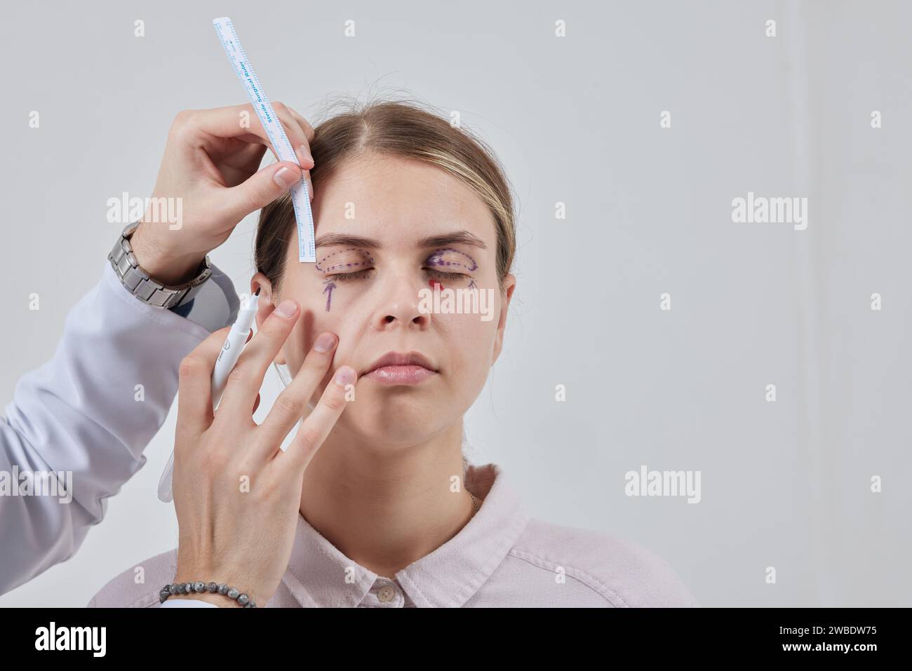 Blepharoplasty of a woman marking on her face before plastic surgery to ...