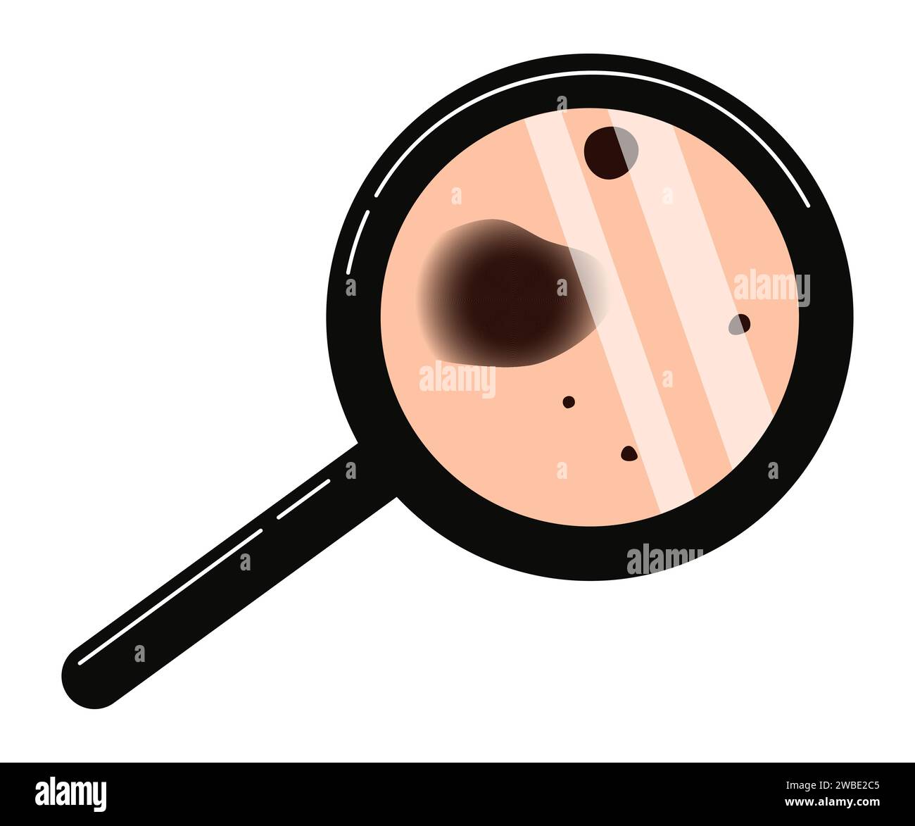 Melanoma diagnosis skin cancer prevention vector illustration Stock Vector Image & Art - Alamy