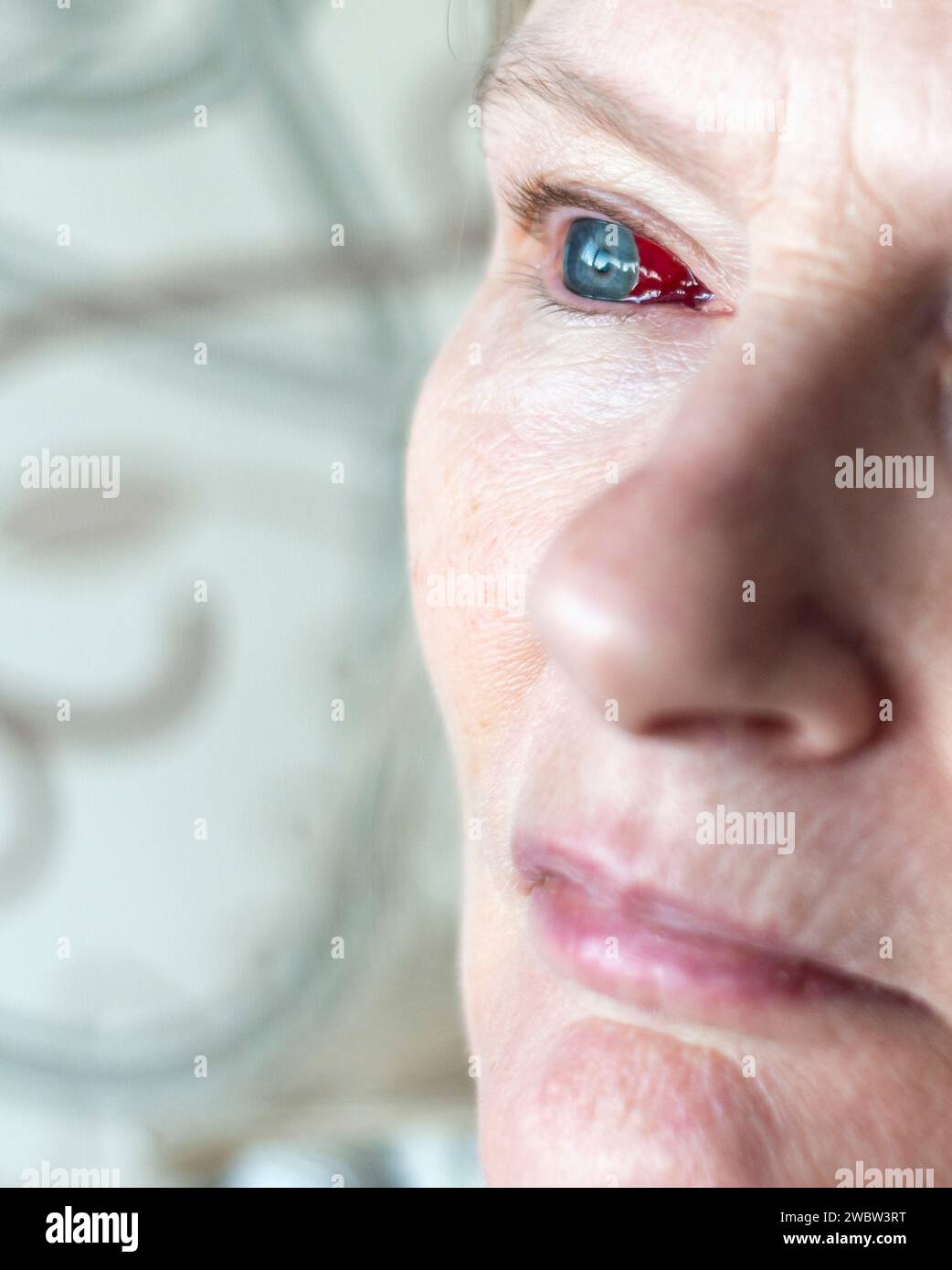 The bleeding from blood tiny vessels beneath the conjunctiva,occured ...
