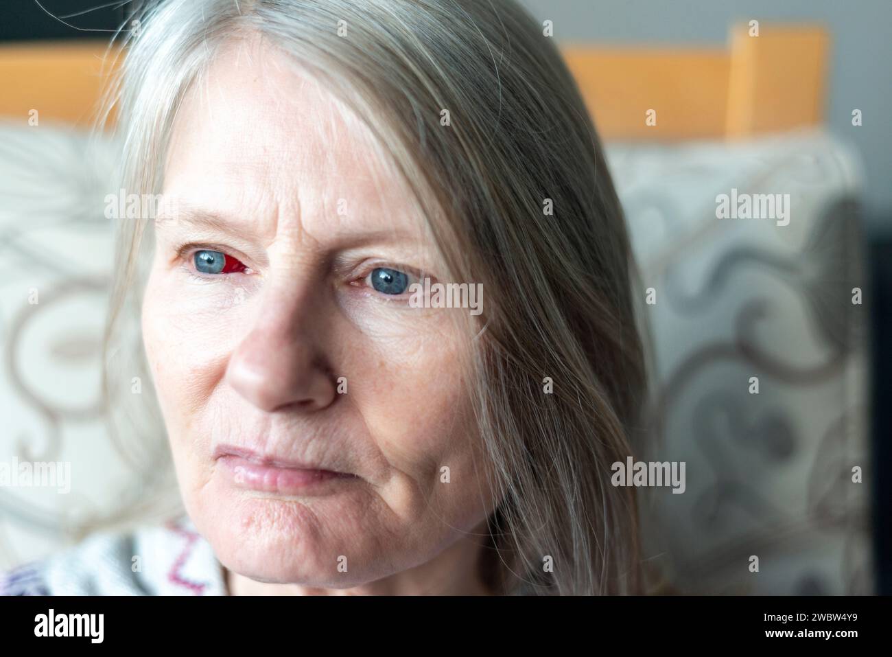 The bleeding from blood tiny vessels beneath the conjunctiva,occured ...