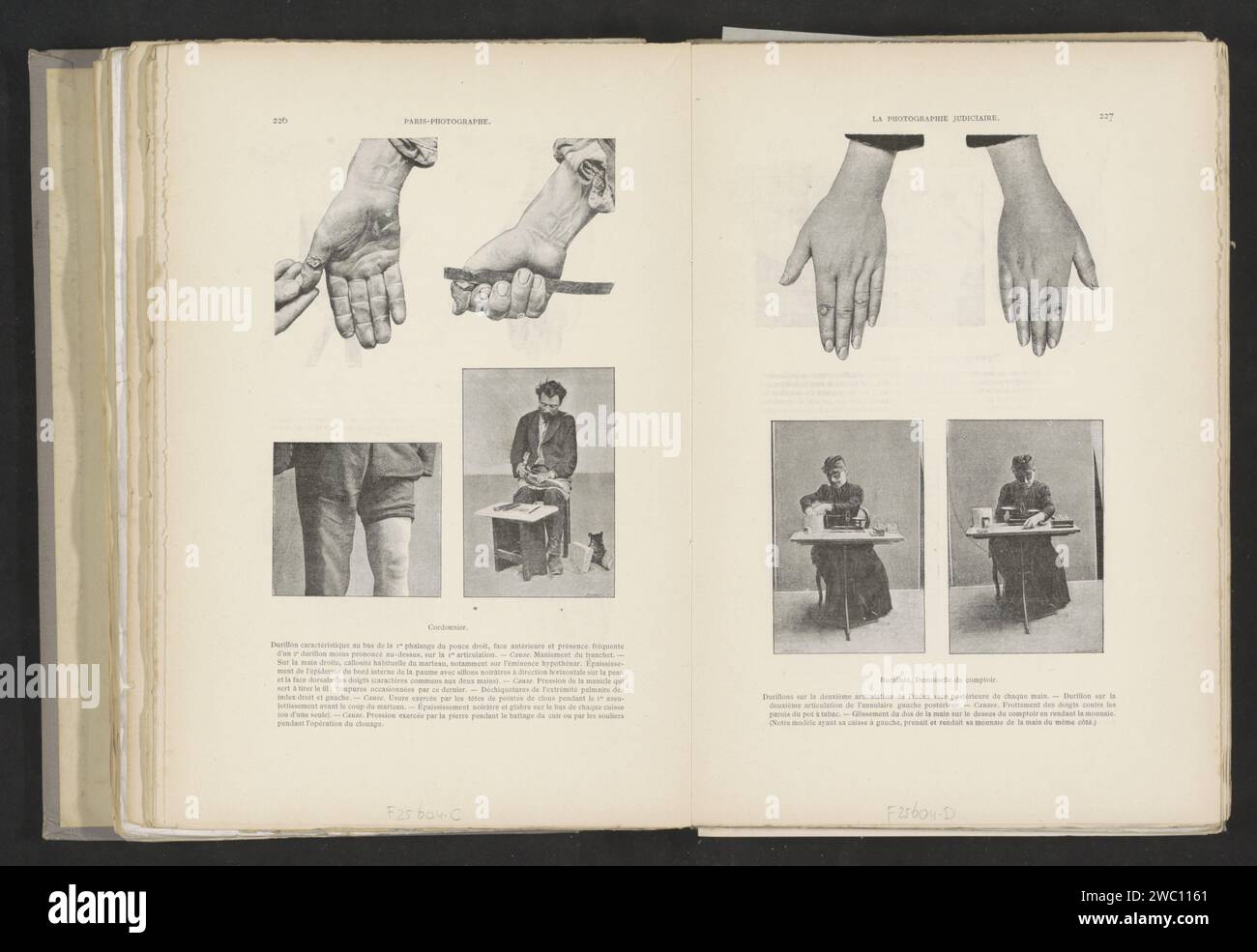 Four images of calluses on the hands and legs of a shoemaker, c. 1881 ...