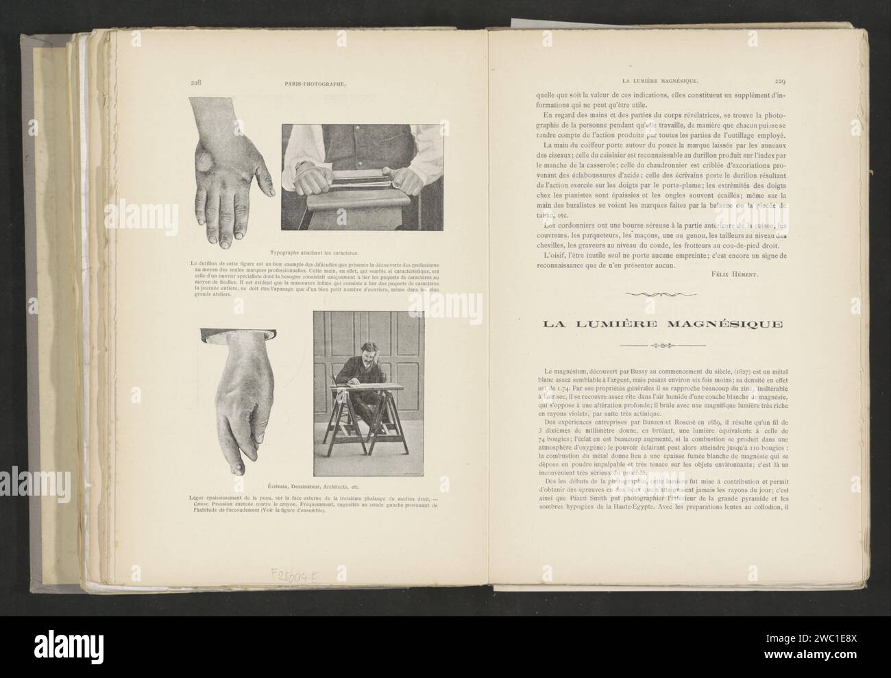 Four images of calluses on the hands of a typographer and a writer, c ...