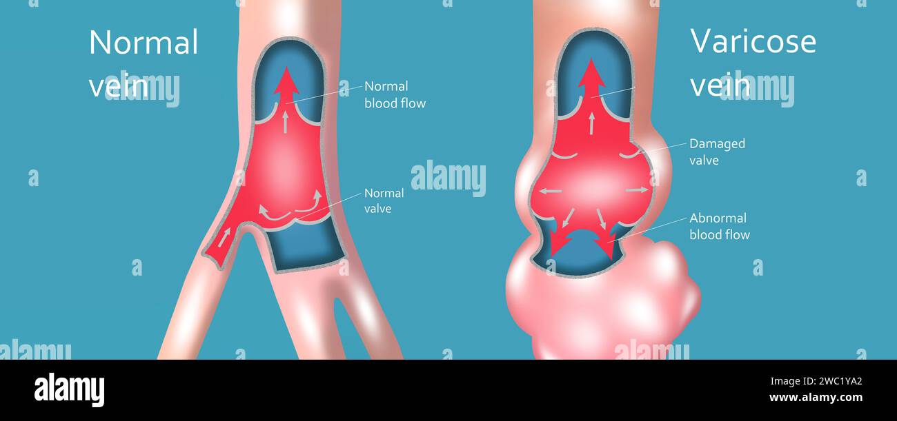 Varicose veins on a female senior legs. The structure of normal and ...