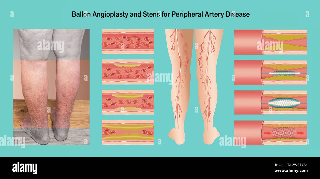 Diagram showing angioplasty for peripheral artery disease illustration ...