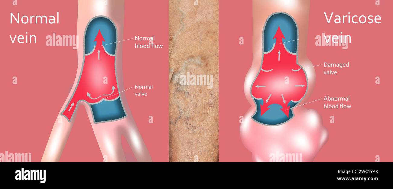 Varicose veins on a female senior legs. The structure of normal and ...