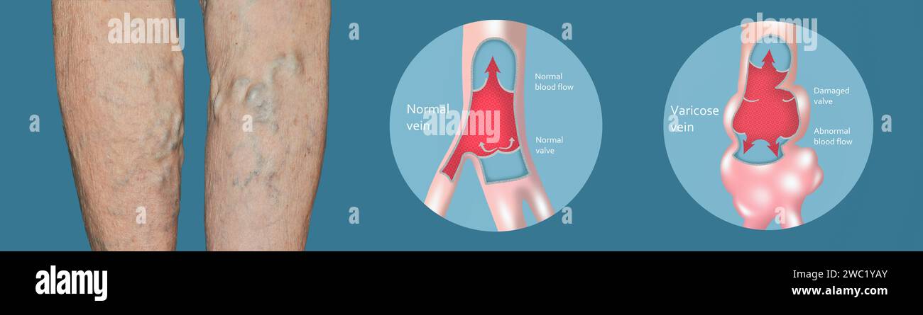 Varicose veins on a female senior legs. The structure of normal and ...