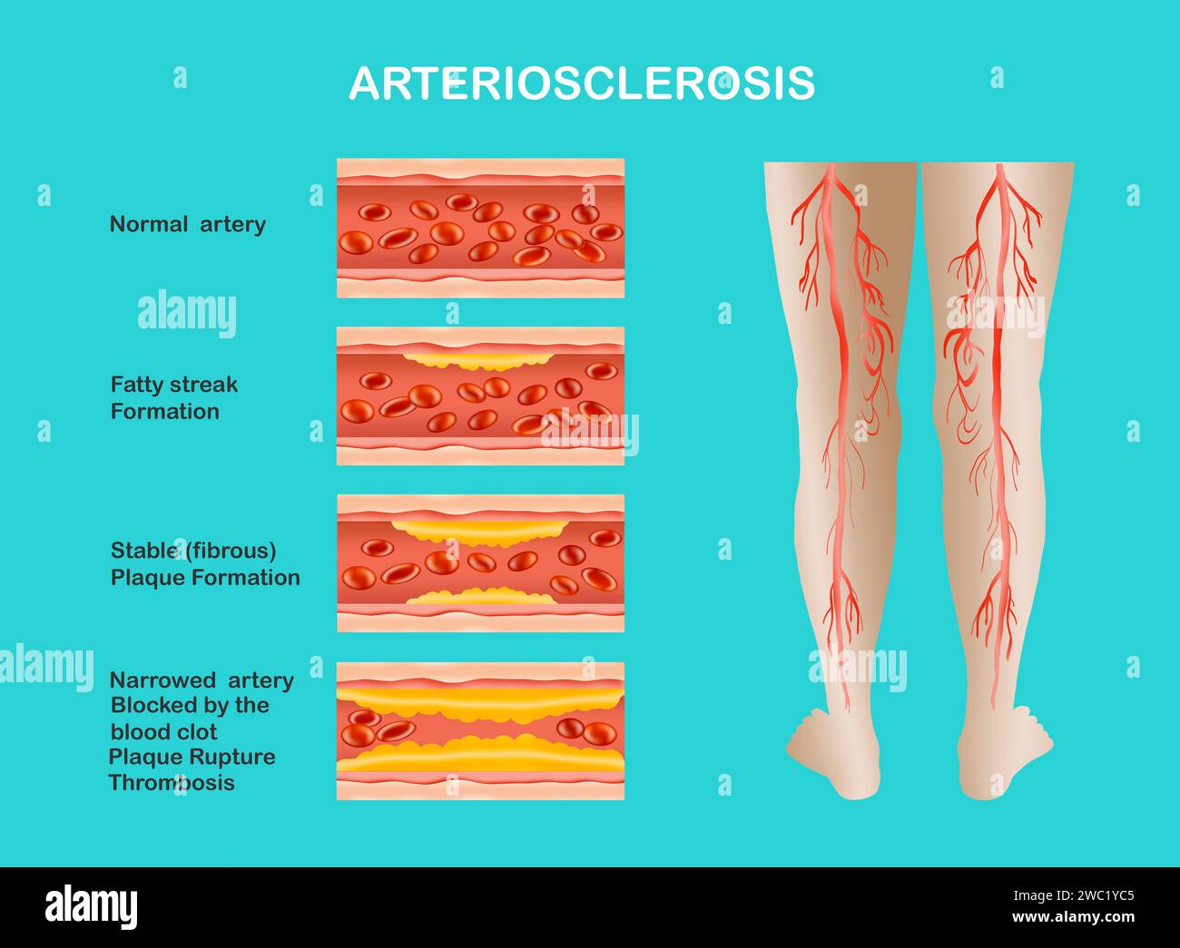 Human legs. Artery with blood cells desease. Concept of dry skin, old ...